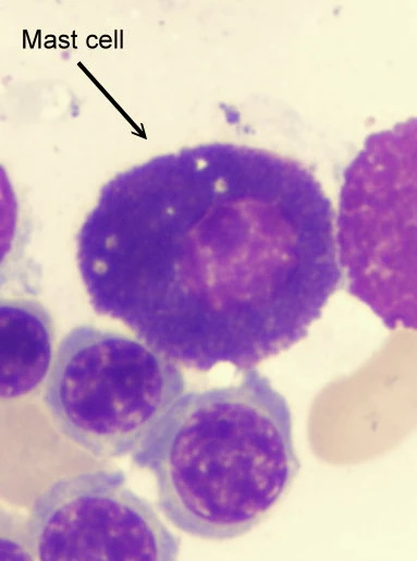 Mast cell - Mastocytosis and Mast Cell Disorders Wiki