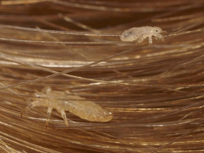 Pediculose - Infomedica Wiki